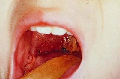 What Is Diphtheria? Symptoms, Risks & When You Might… | Ready Health